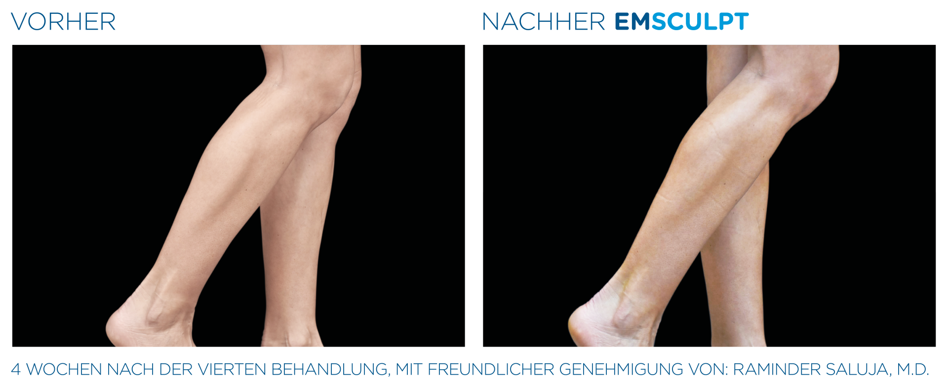 Emsculpt - Toth Aesthetic | Zwickau